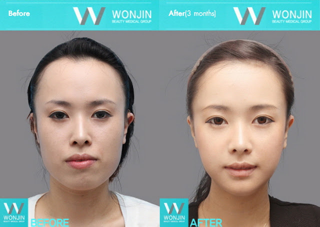 [Before and After Photos] Korean Face Contouring - 짱이뻐!