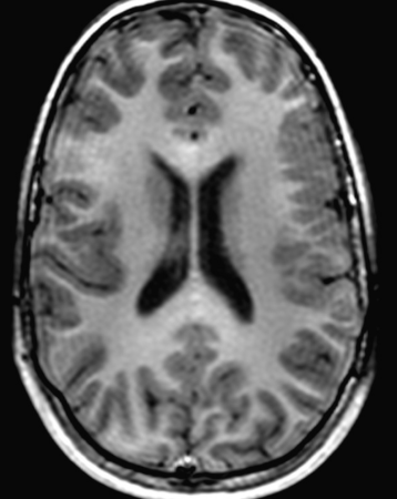 Polymicrogyria-Mayo Radiology