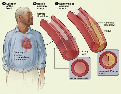 What Is Atherosclerosis ? ~ Public Health and Education