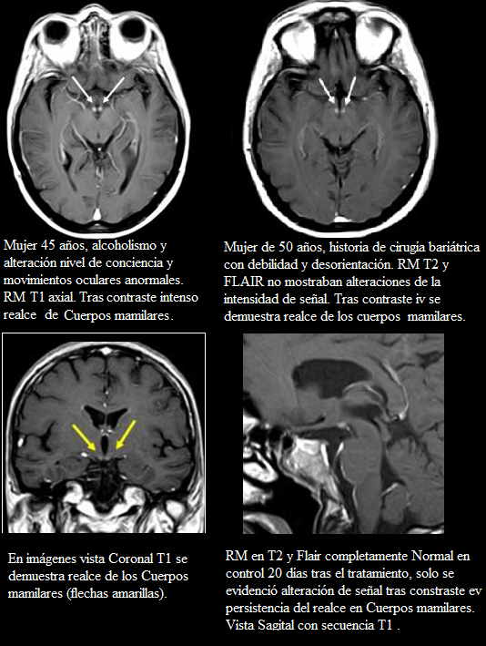 NeuroAnatomía Dr. William Ganem: Encefalopatía de Wernicke