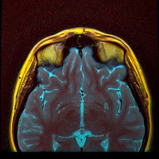 Nevit's blog: Color MRI of Orbita
