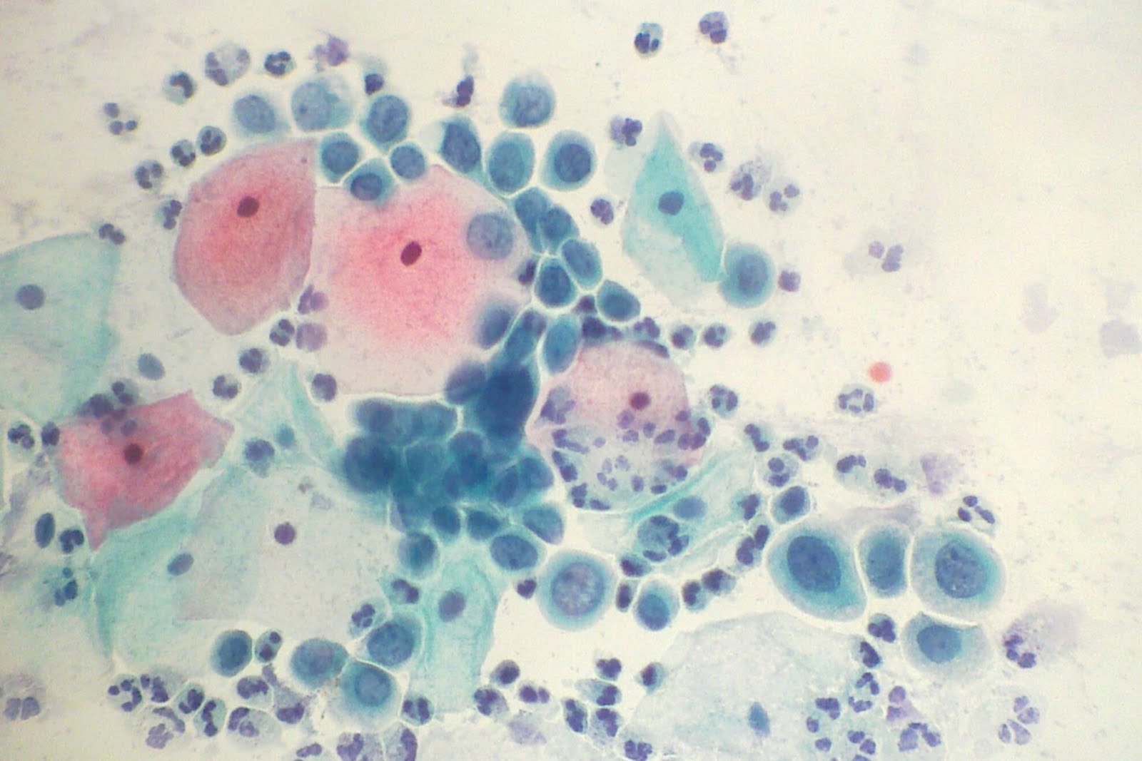 The Cell Hunter Society: Case No. 3 Pap Smear (CP)