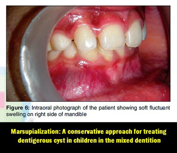 MARSUPIALIZATION: A conservative approach for treating dentigerous cyst ...
