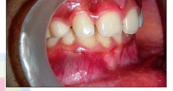 MARSUPIALIZATION: A conservative approach for treating dentigerous cyst ...
