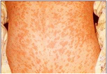 Penyakit Campak Pada Orang Dewasa - Perumperindo.co.id