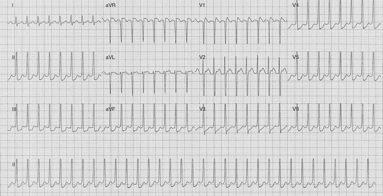 ECG of the Week: ECG of the Week - 23rd June 2014 - Interpretation