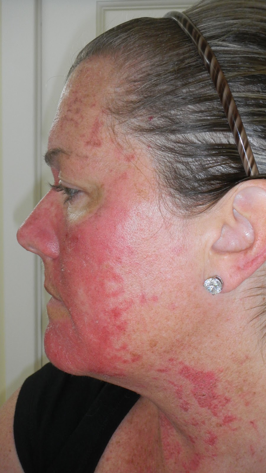 Efudex and Me 2013: 06/03/13