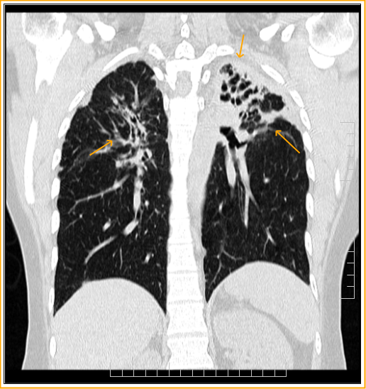 Fibrosing sarcoidosis-CT - Sumer's Radiology Blog