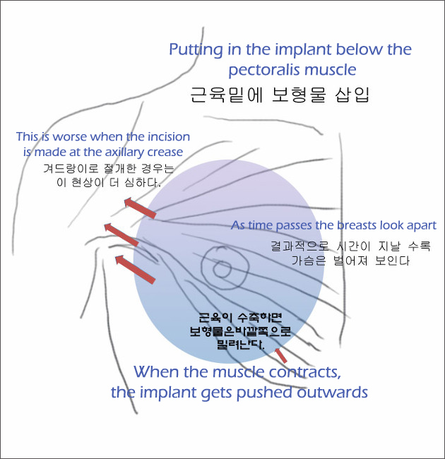 Dr. Lee Breast augmentation Korea: Dual plane teardrop - breast ...