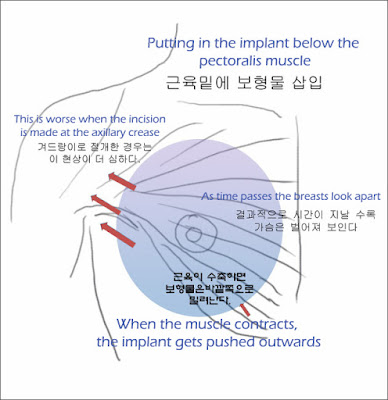 Dual plane teardrop - breast augmentation Korea KIES-U