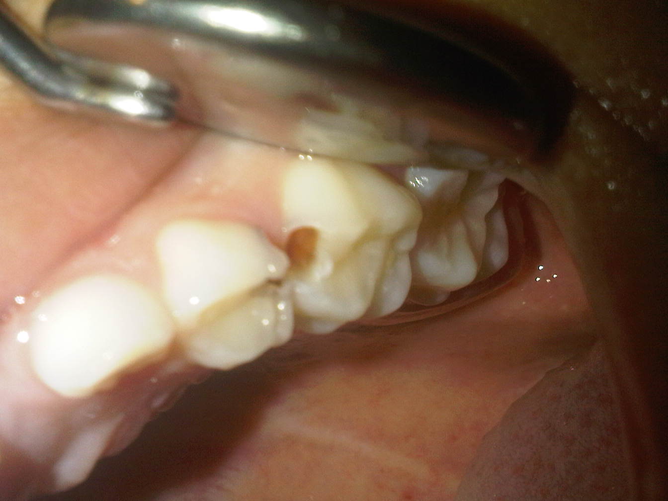 INTERNADO DE ODONTOLOGÍA 2012: RESTAURACIÓN DE CLASE II EN PACIENTE ...