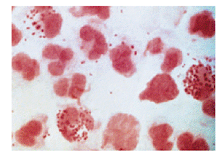 GUIAS Y REVISIONES MEDICAS: INFECCIONES POR GONOCOCO