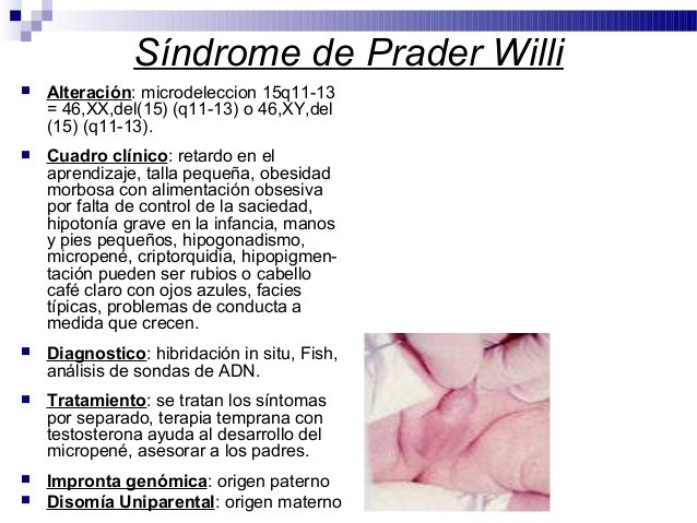 El niño con retraso mental y Síndrome de Down : Síndrome de Prader-willi.