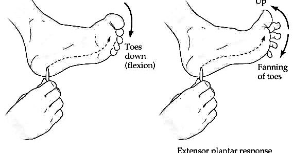 Plantar reflex ~ Online Preparation for NEET, AIIMS, USMLE, UPSC, PGI ...