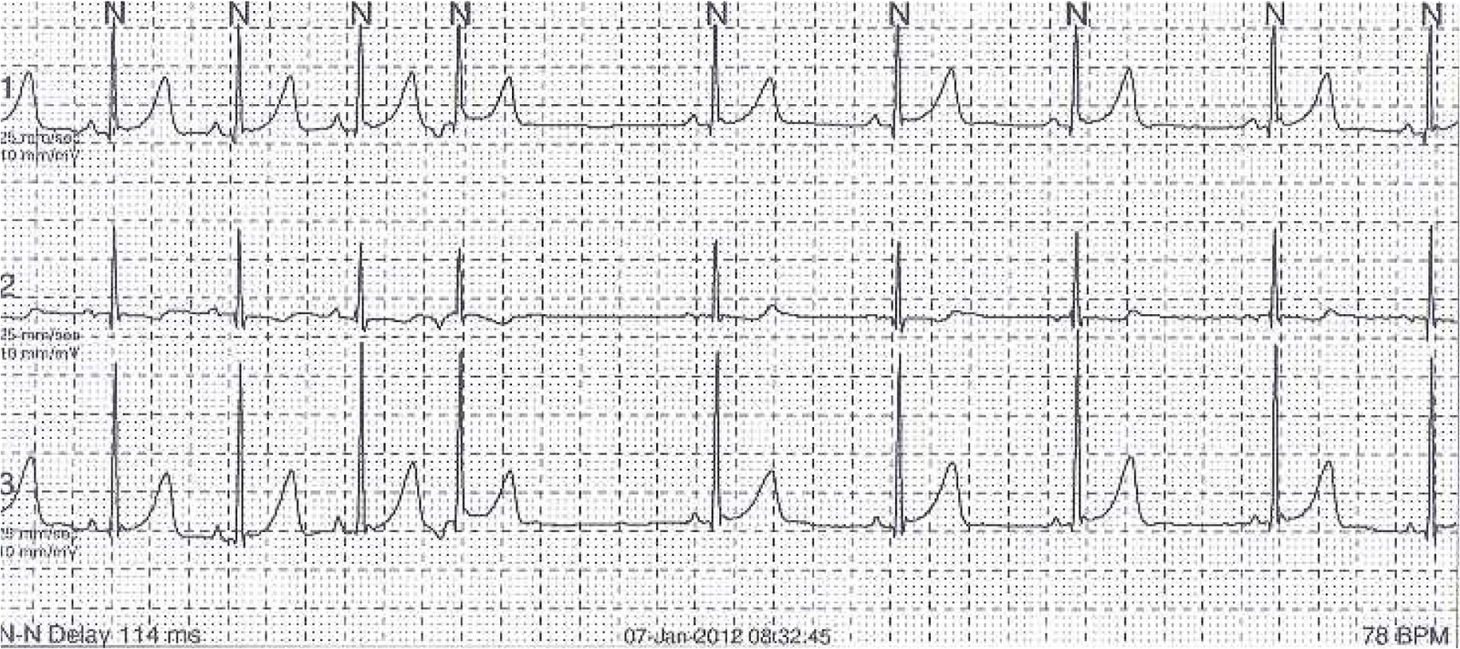 Pedi cardiology: Atrial ectopy