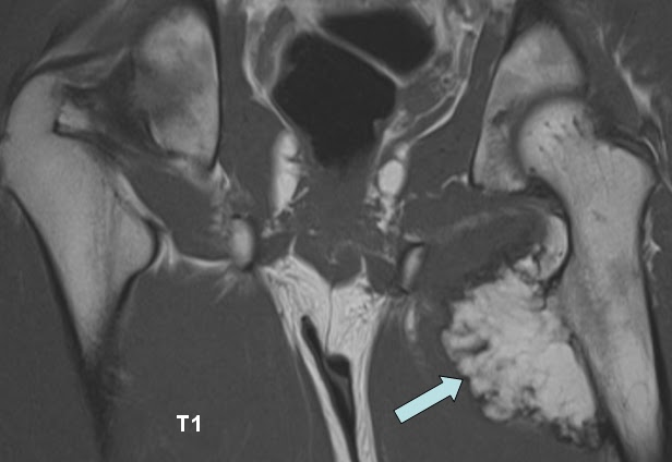 mricases: Large Sessile Osteochondroma Of The Lesser Trochanter Of ...