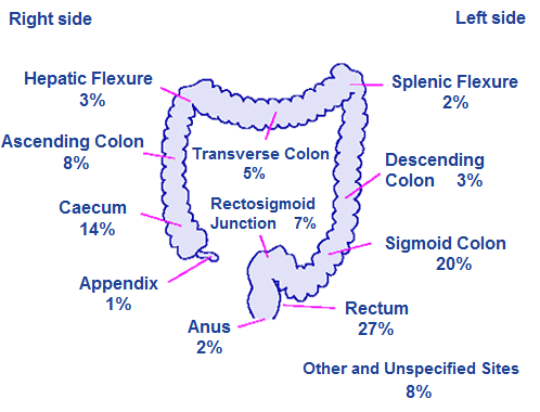 Colon Cancer