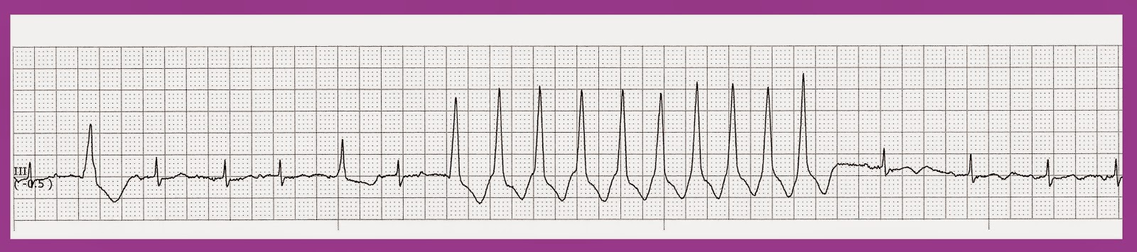 Float Nurse: Various Ventricular Tachycardias