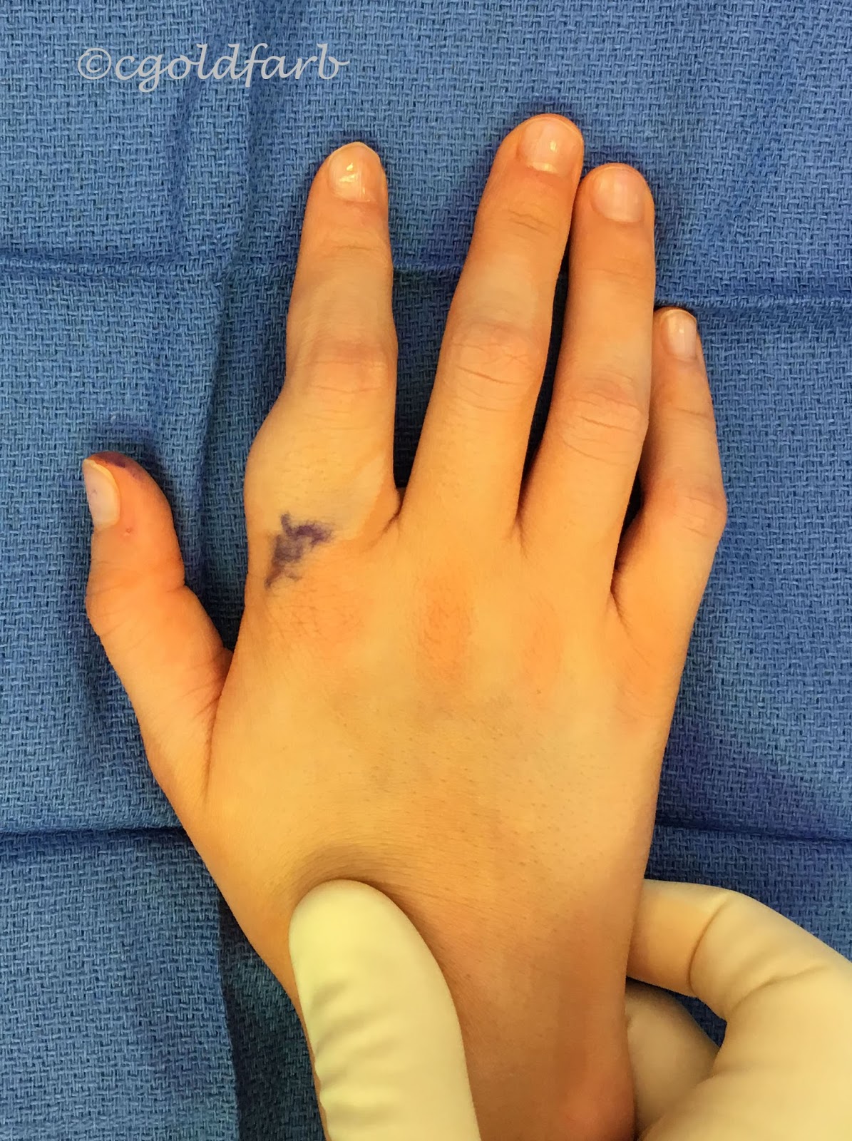 Surgery for Olliers Disease | Congenital Hand and Arm Differences ...