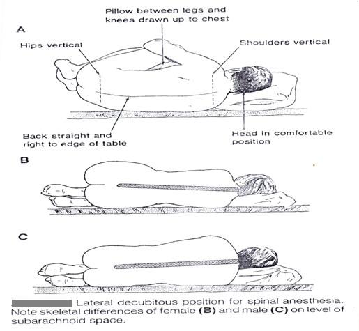 Spinal Anestesia - Anesthesia - Anesthesiology