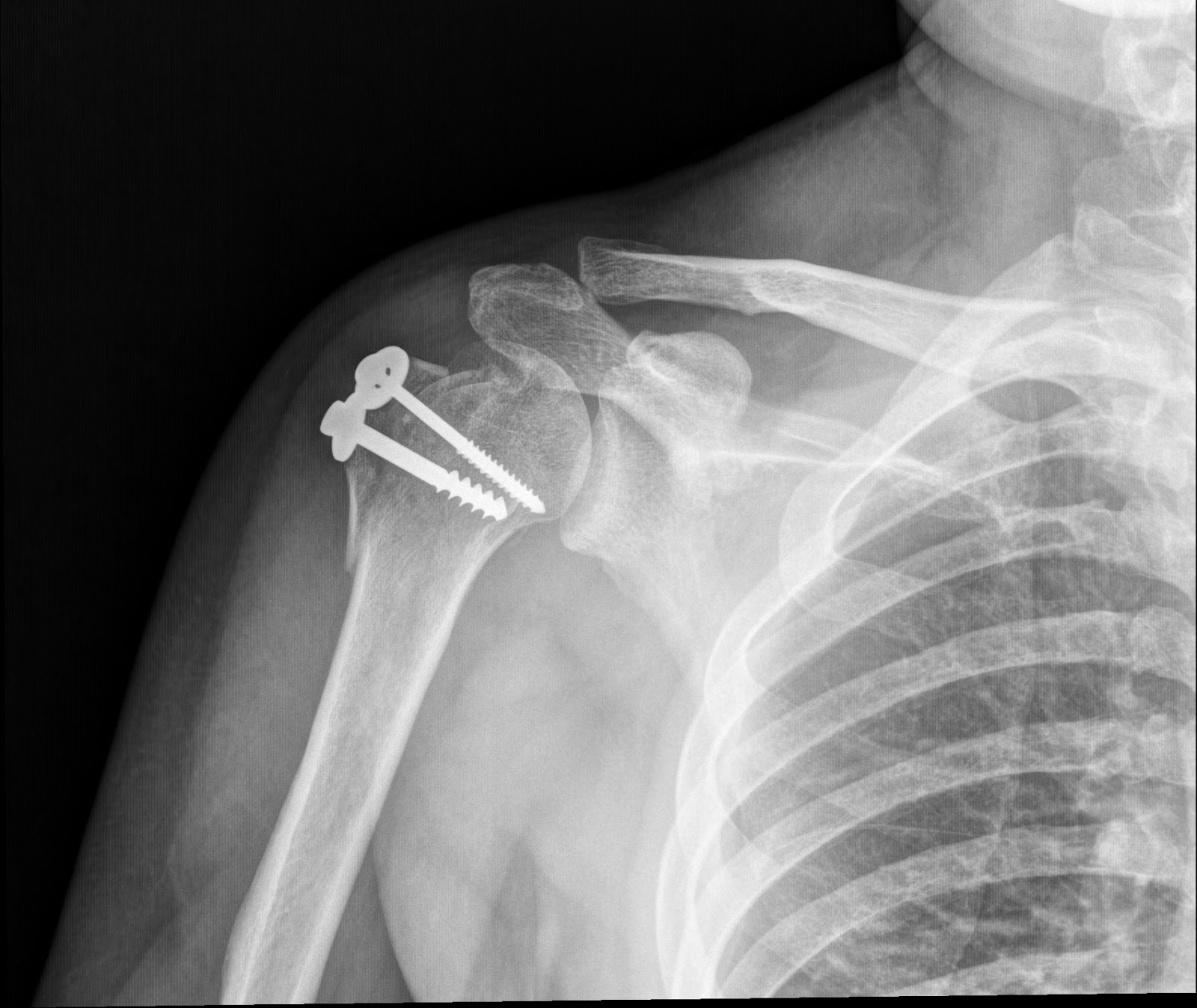 Shoulder X Ray Anatomy