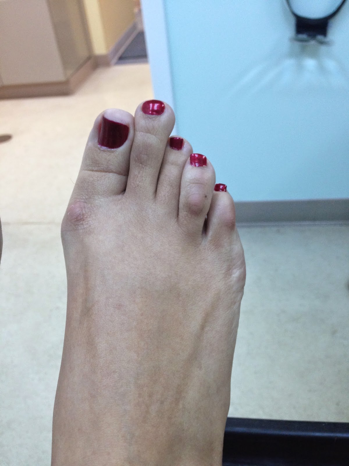 My Toe Shortening Surgery Experience : First Toe, Left Foot!