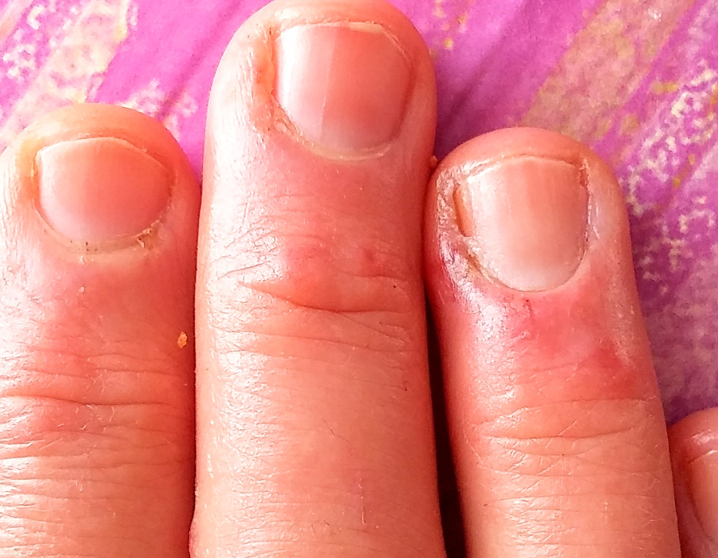 Here is a close-up of the fingers so you can see the sore, they are ...
