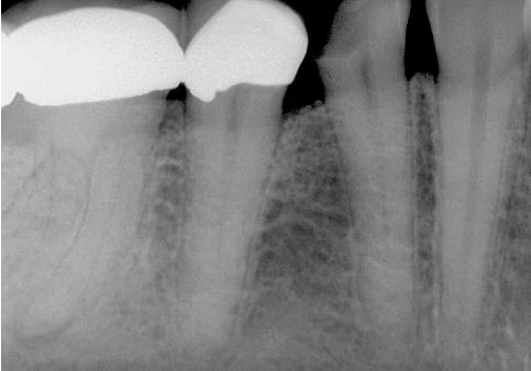 Dentistry lectures for MFDS/MJDF/NBDE/ORE: A Note On Pulp Vitality ...