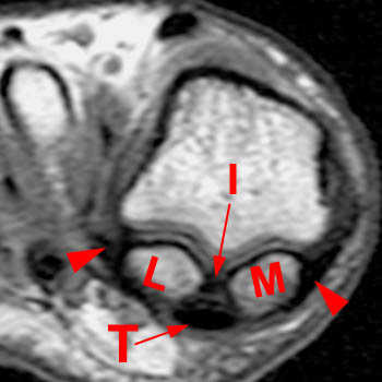 MRI Musculo-Skeletal Section: Turf toe.