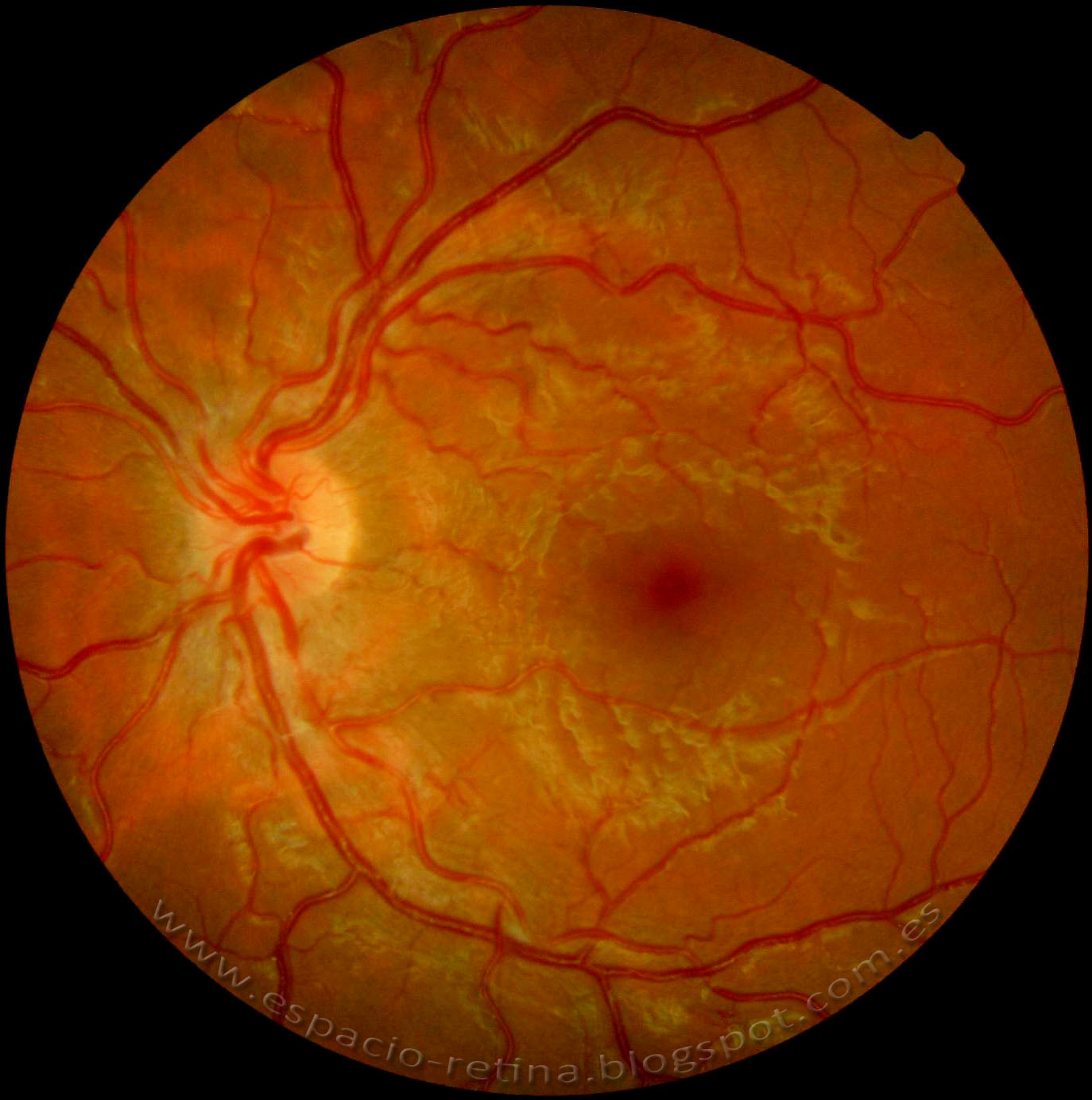 ESPACIO RETINA: Retinografía normal.