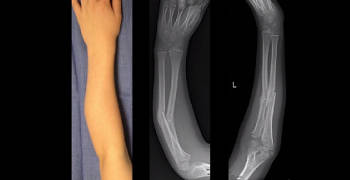 Fractura del brazo - Botiquin de primeros auxilios PRO!!