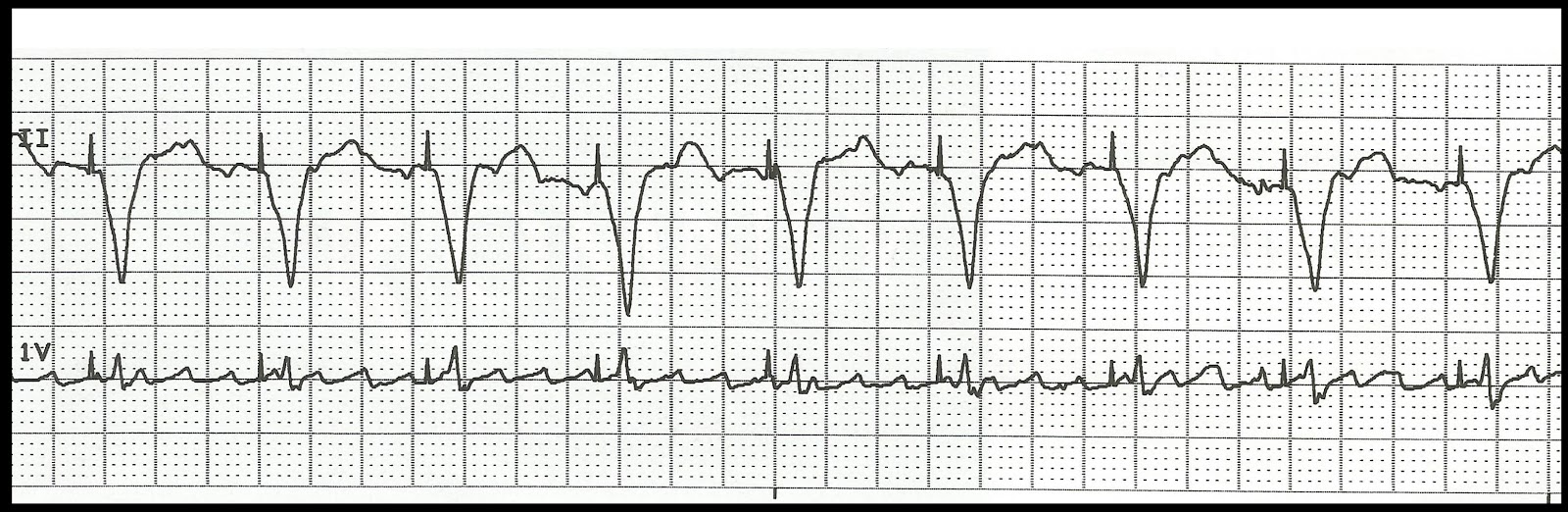 Practice EKG Rhythm Strips 156