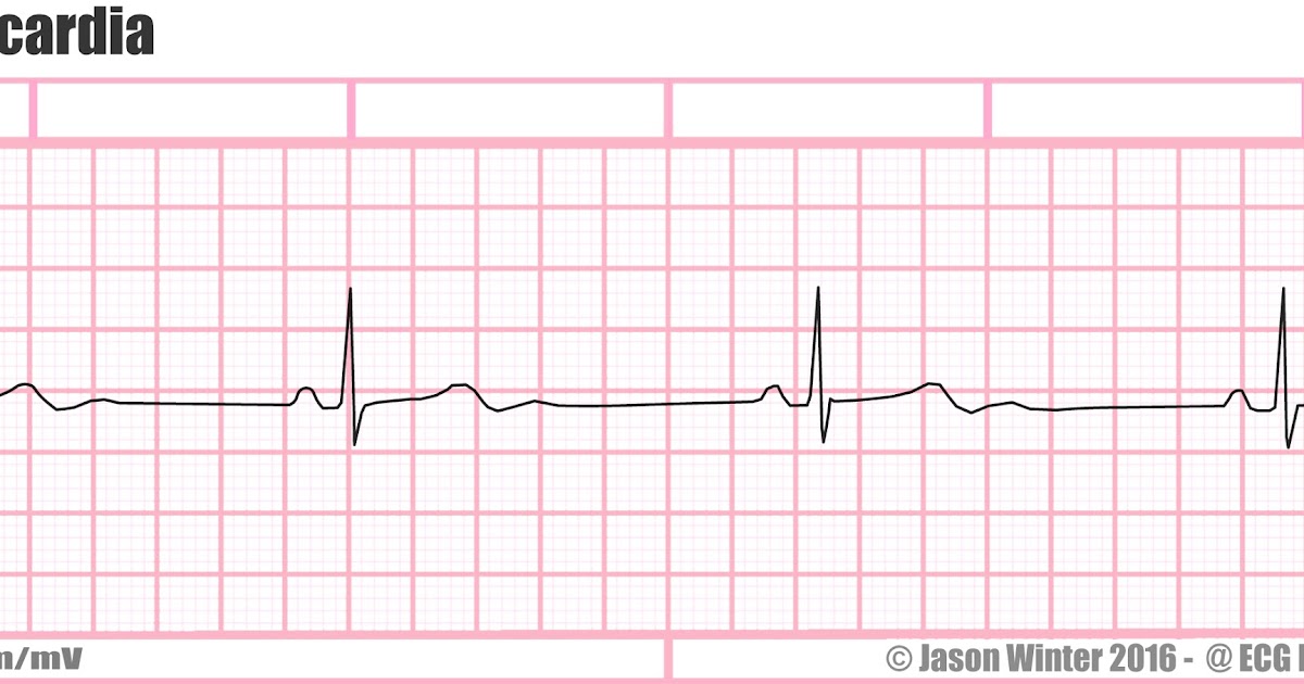 ECG Educator Blog : Sinus Bradycardia