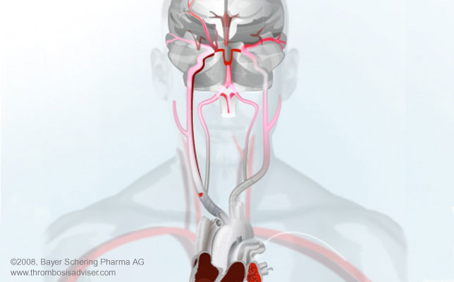 Emboli Adalah, Definisi Emboli, Pengertian Emboli ~ TEKNOBIOMEDIK