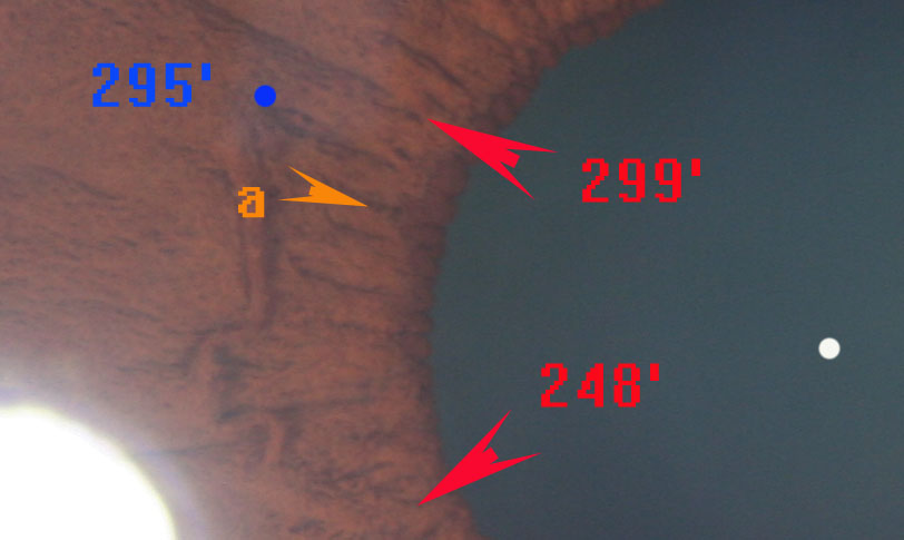 Modern & Multidimensional Iridology: Radial Furrows, Hyperlastic ...