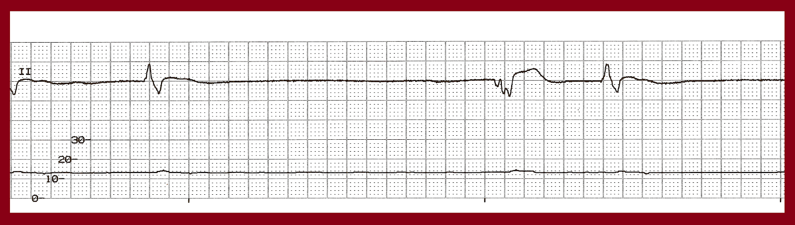 Practice EKG Strips 325