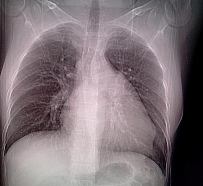 Patent ductus arteriosus-CT - Sumer's Radiology Blog