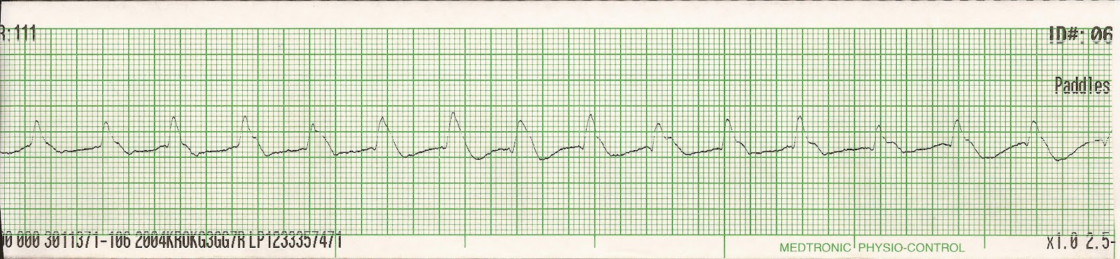 Megacode Pulseless Vf Vt Part 2