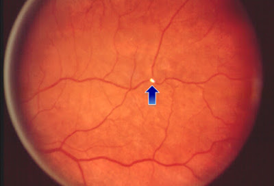 Hollenhorst Plaque Images, ICD-10, Definition, Symptoms, Causes ...