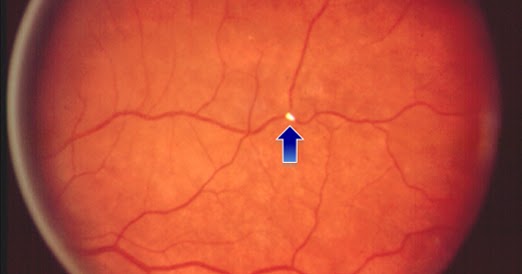 Hollenhorst Plaque Images, ICD-10, Definition, Symptoms, Causes ...