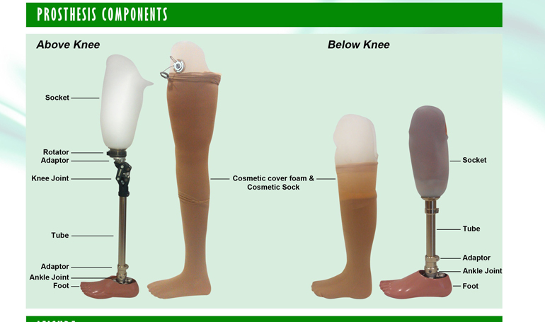 Knee Replacement Surgery