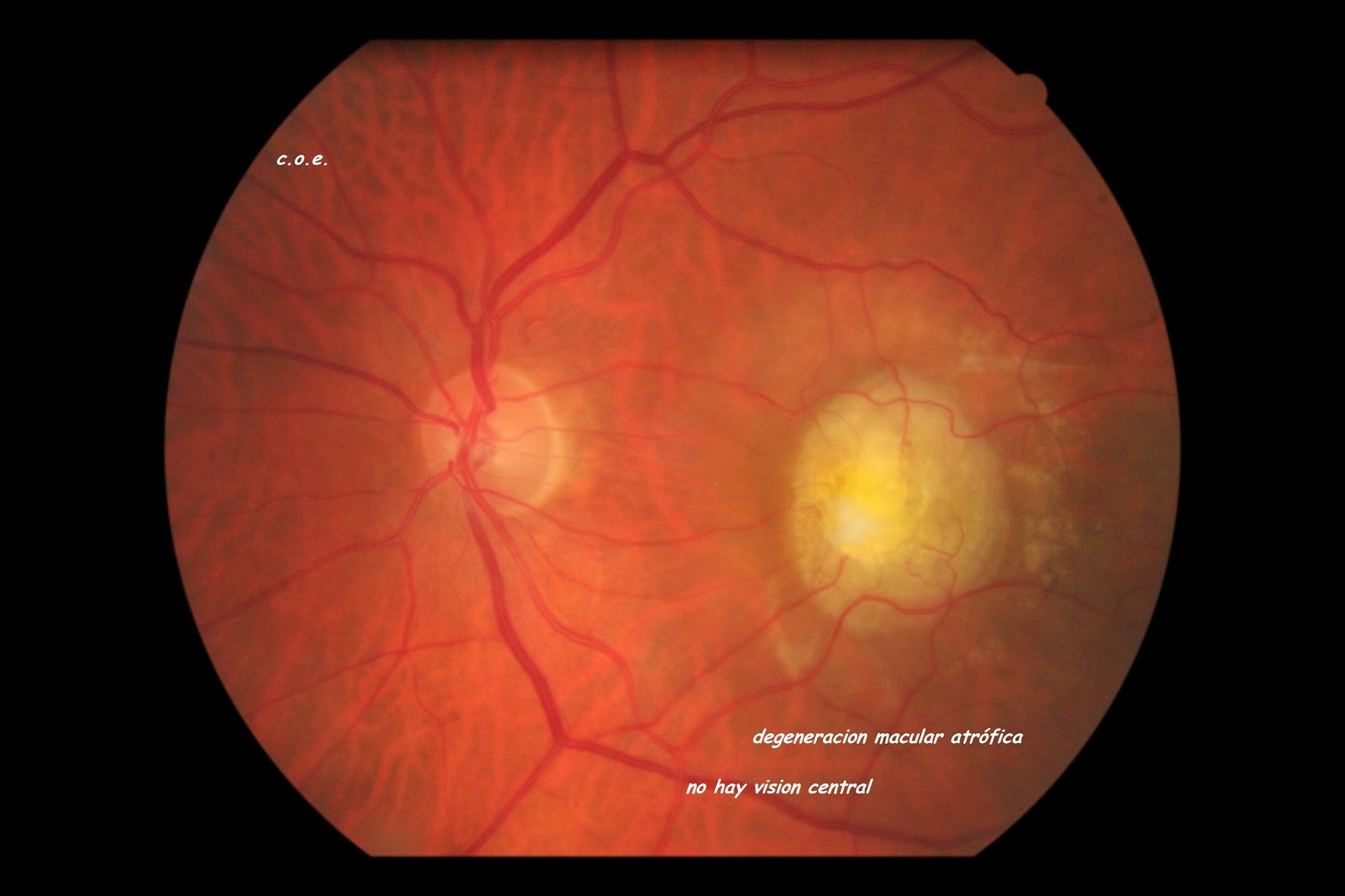 DEGENERACION MACULAR : RETINOGRAFIAS II