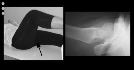 Quadril e Pelve- Quadril Axiolateral Cross Table