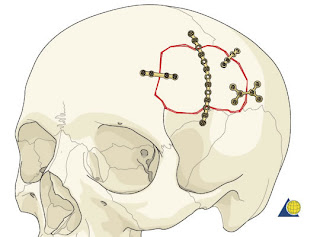 Neuro Operations: Minimal Invasive Surgery - Cranioplasty