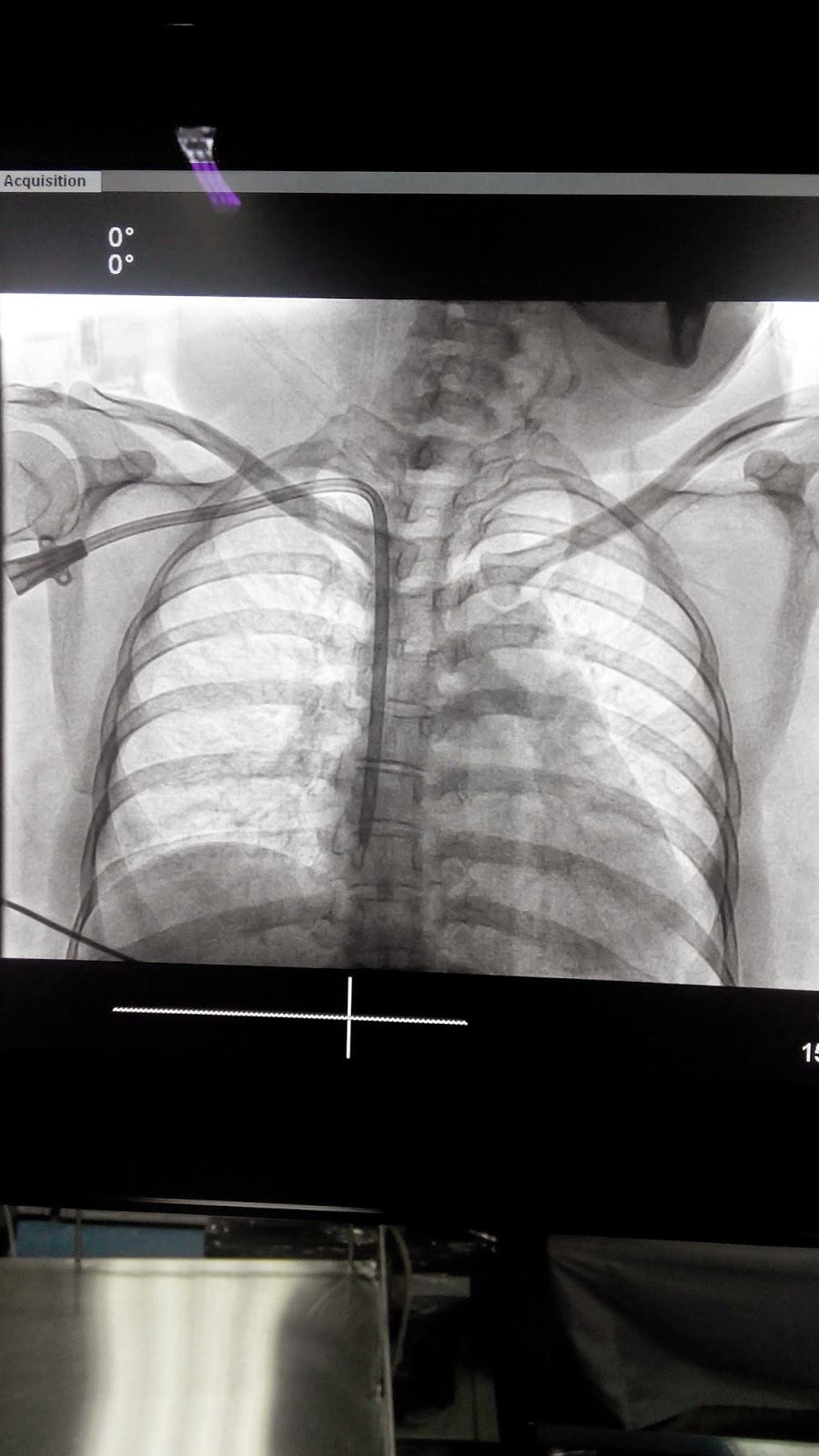 RUANG PRAKTEK BEDAH - DOKTER RAMZI SPB (K) V: CDL yang di pasang ...