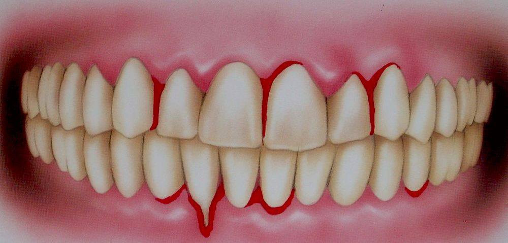 PERIODONTIA: O que é gengivite? | Directorio Odontológico