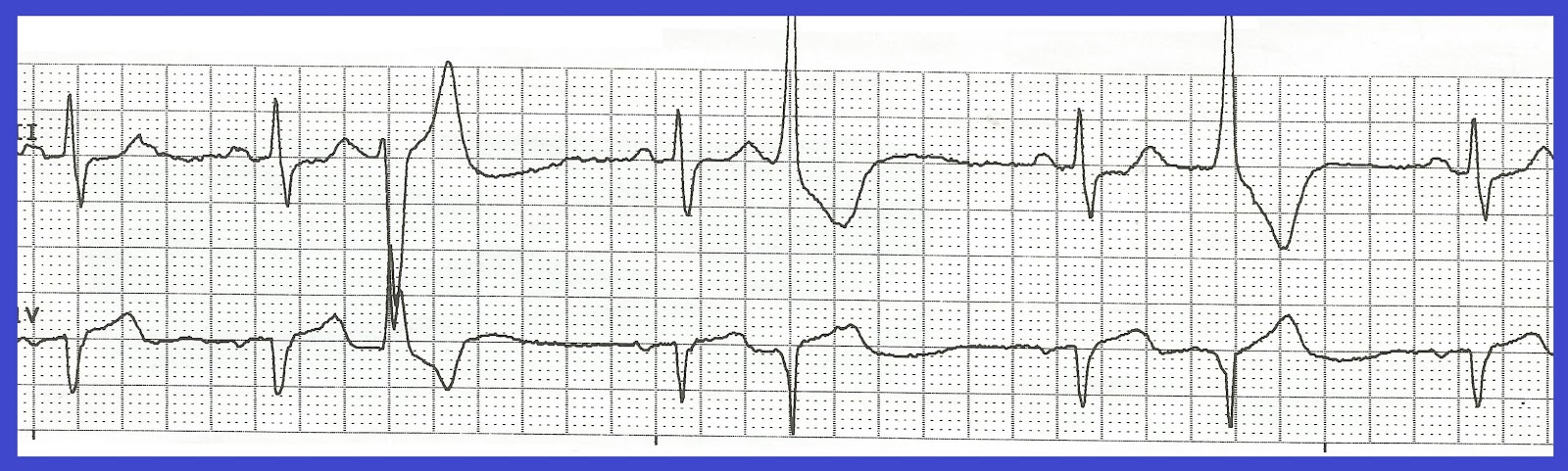 Basic EKG Rhythm Test 11