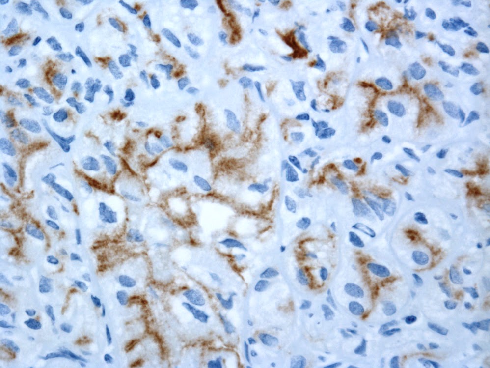 neuropathology blog: A case of renal cell carcinoma metastatic to a ...