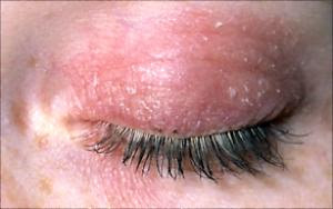 Eyelid: Red And Swollen Eyelids