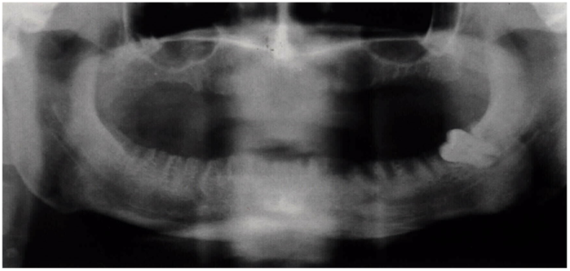 Dentistry and Medicine: Surgical management of Unerupted and Impacted teeth